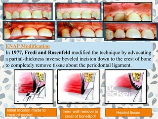 GINGIVAL SURGICAL TECHNIQUES IN PERIODONTOLOGY | PPTX