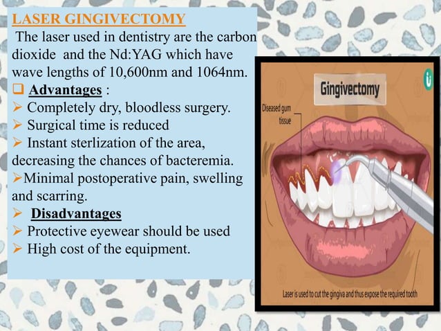 GINGIVAL SURGICAL TECHNIQUES IN PERIODONTOLOGY | PPTX | Dental Health ...