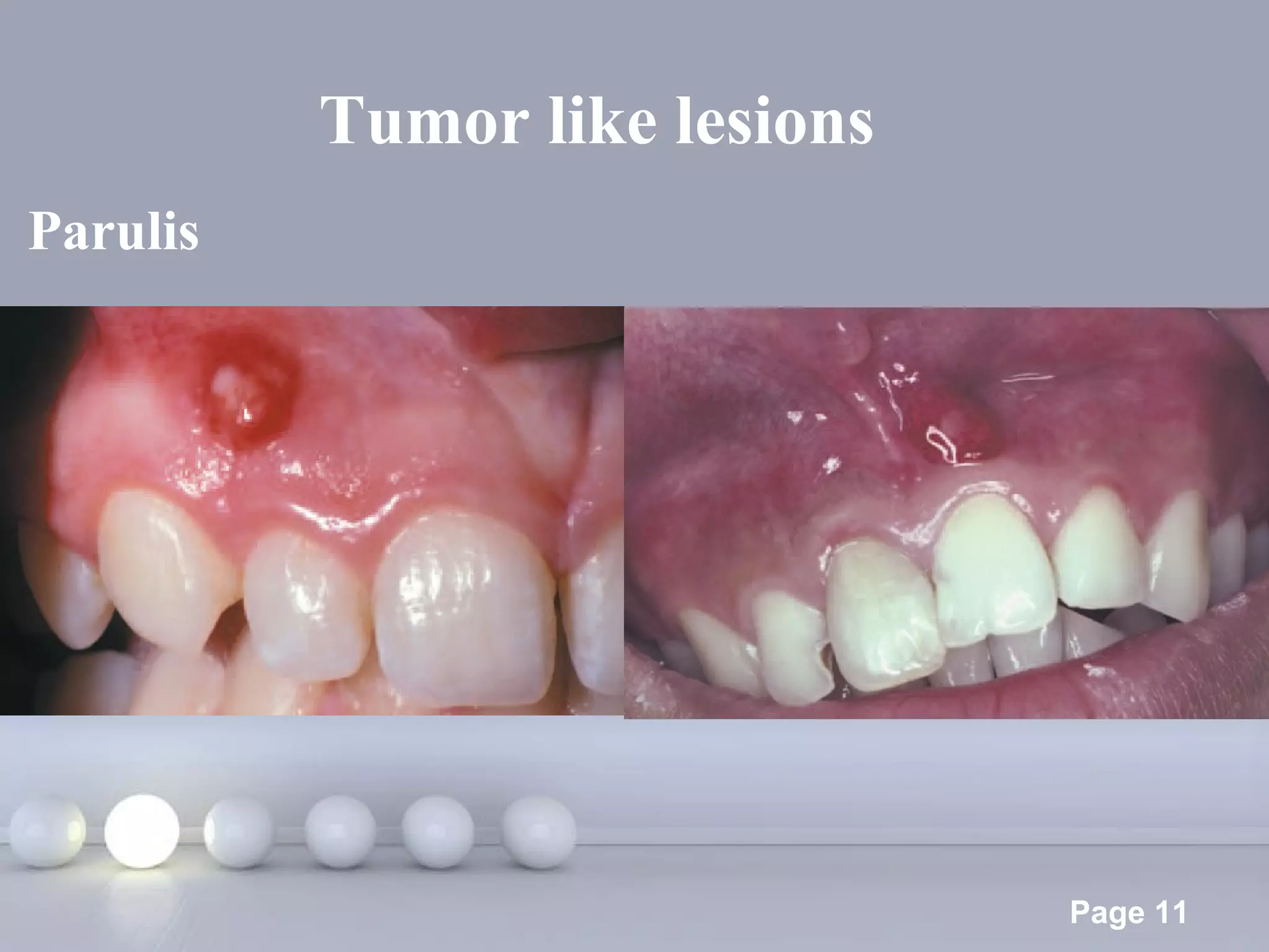 Gingival swellings differential diagnosis | PPT