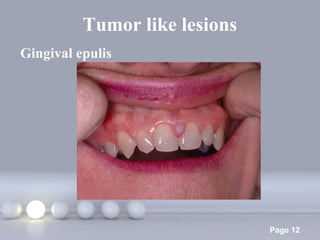 Gingival swellings differential diagnosis | PPT