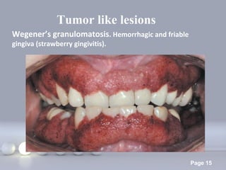 Gingival swellings differential diagnosis | PPT