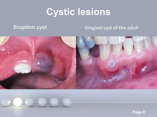 Gingival swellings differential diagnosis | PPT