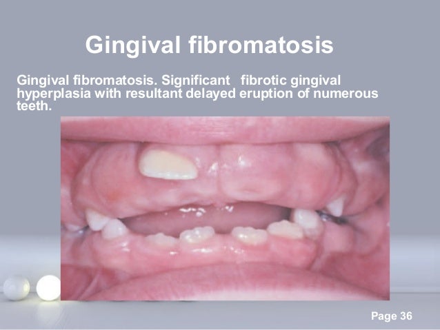 Gingival swellings differential diagnosis