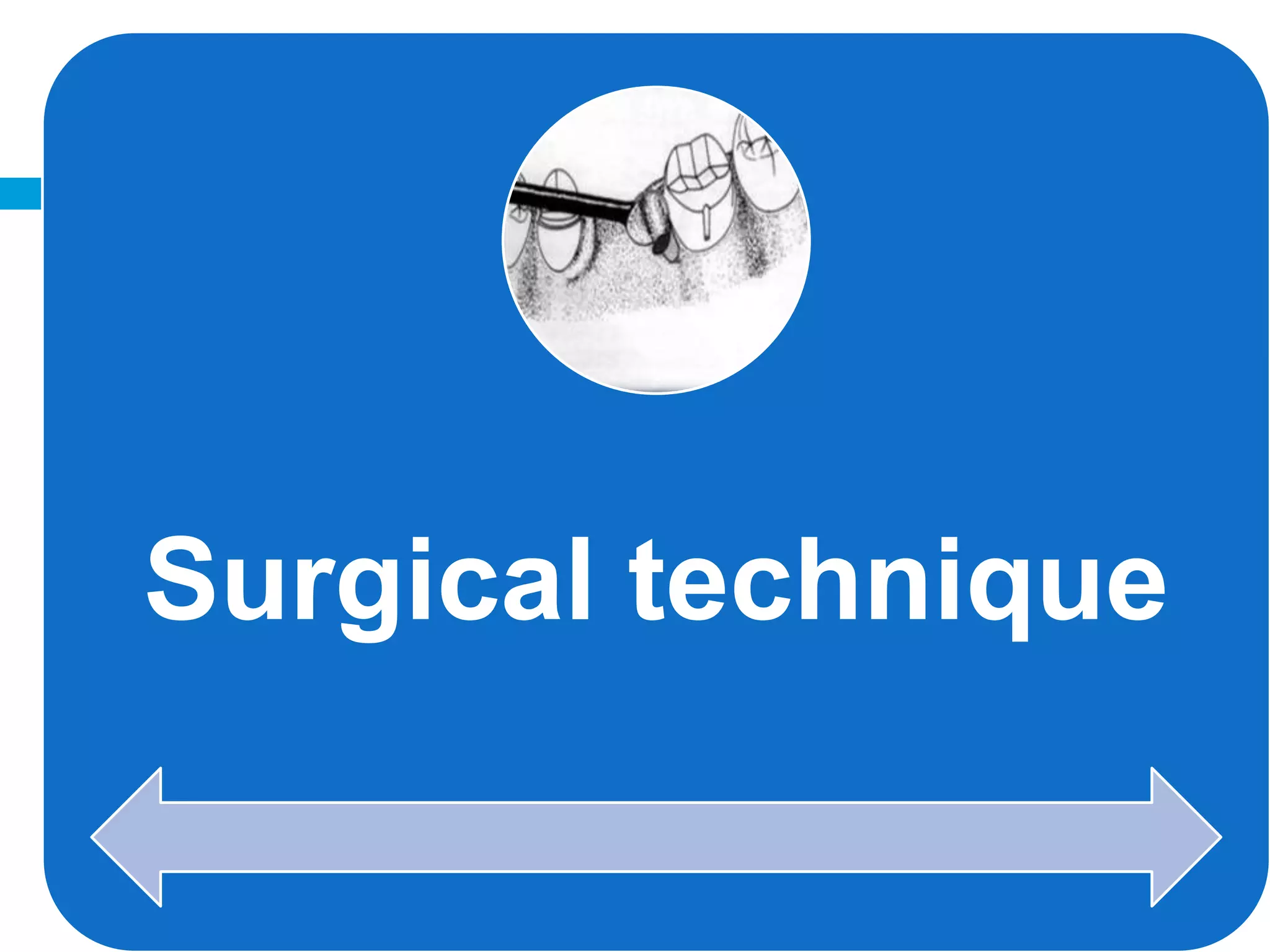 Gingival tissue displacement in fpd | PPTX
