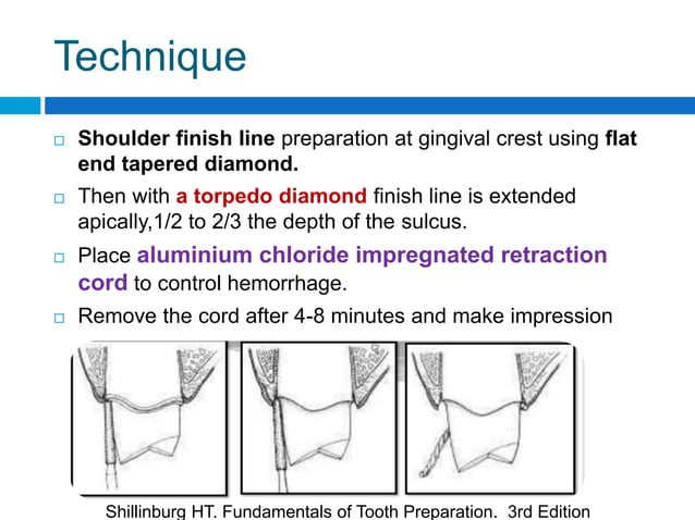Gingival tissue displacement in fpd | PPTX