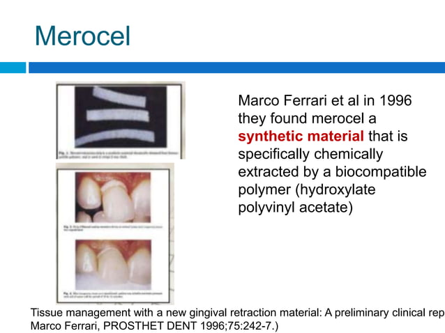 Gingival tissue displacement in fpd | PPTX