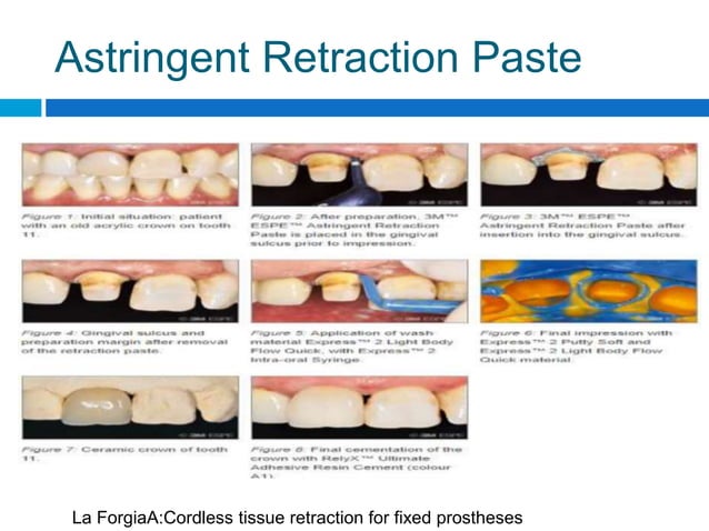 Gingival tissue displacement in fpd | PPTX