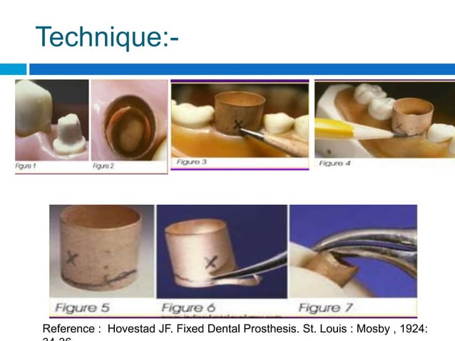 Gingival tissue displacement in fpd | PPTX