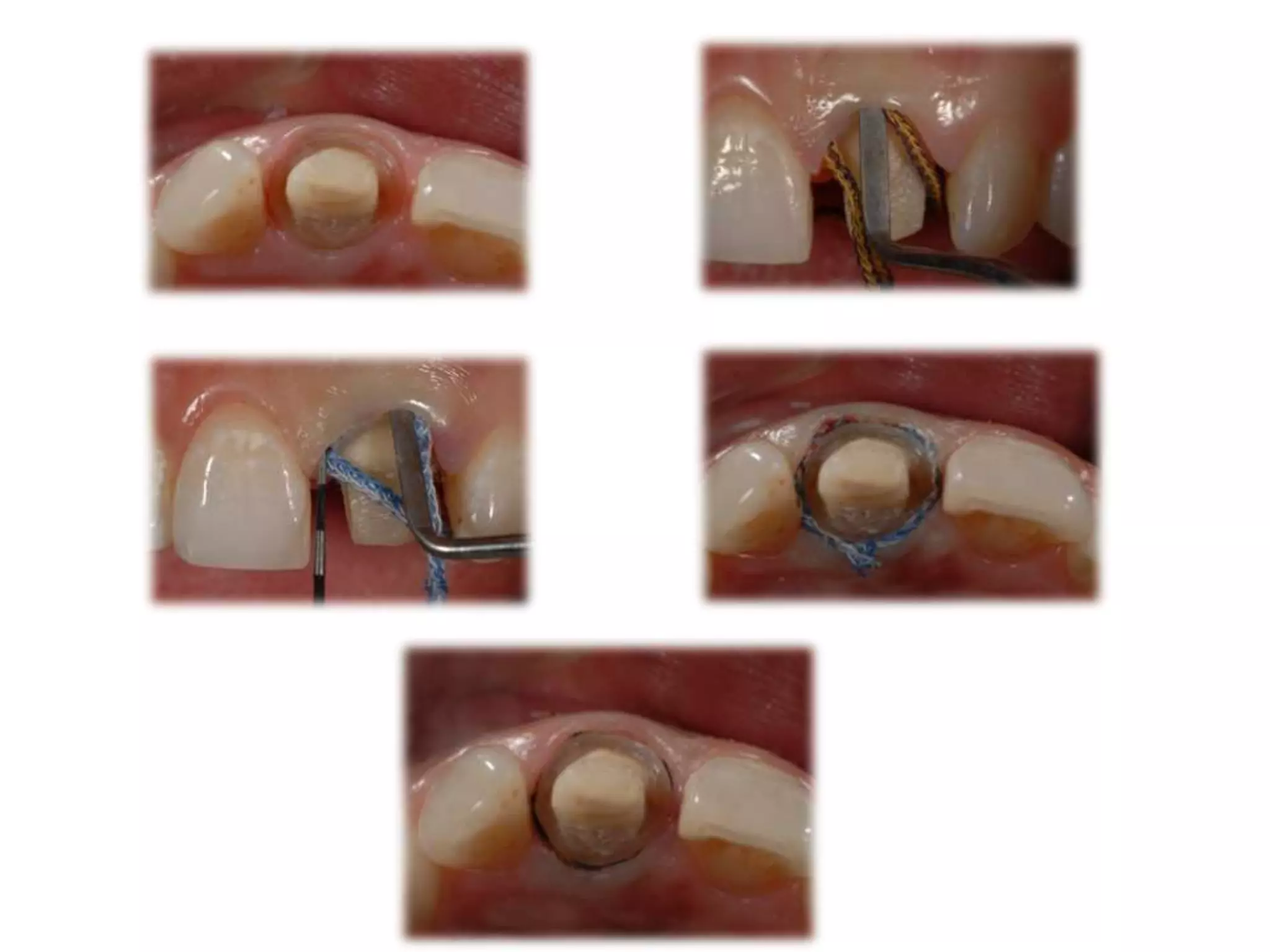 Gingival tissue management | PPTX