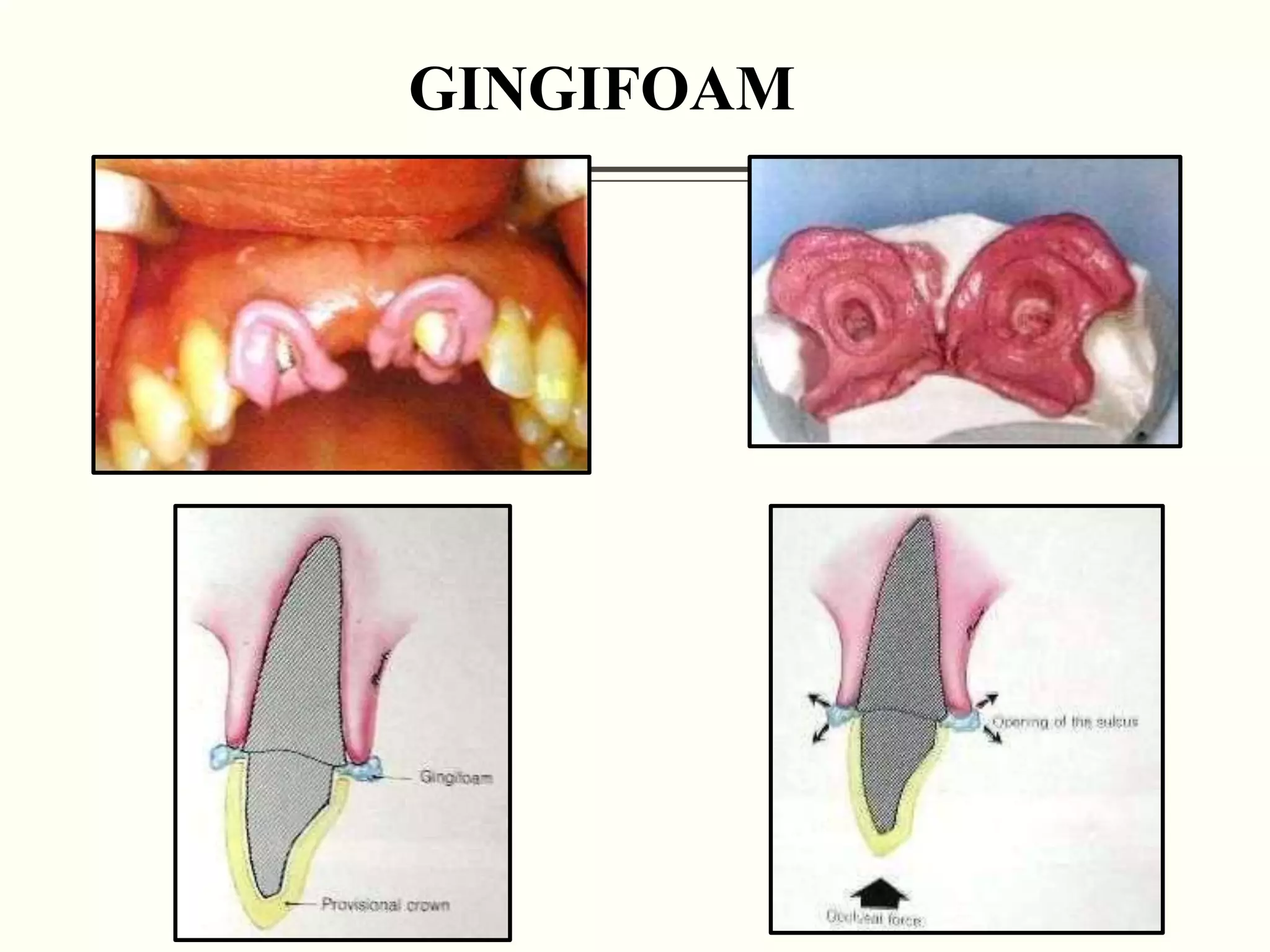 GINGIVAL TISSUE RETRACTION.pptx