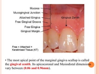 Gingival Margin