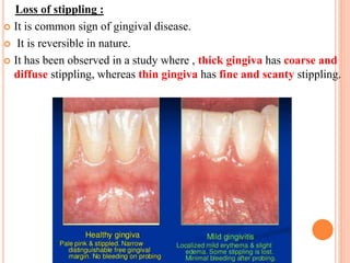 Normal Gum Stippling