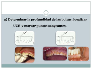 Gingivectomia bisel interno