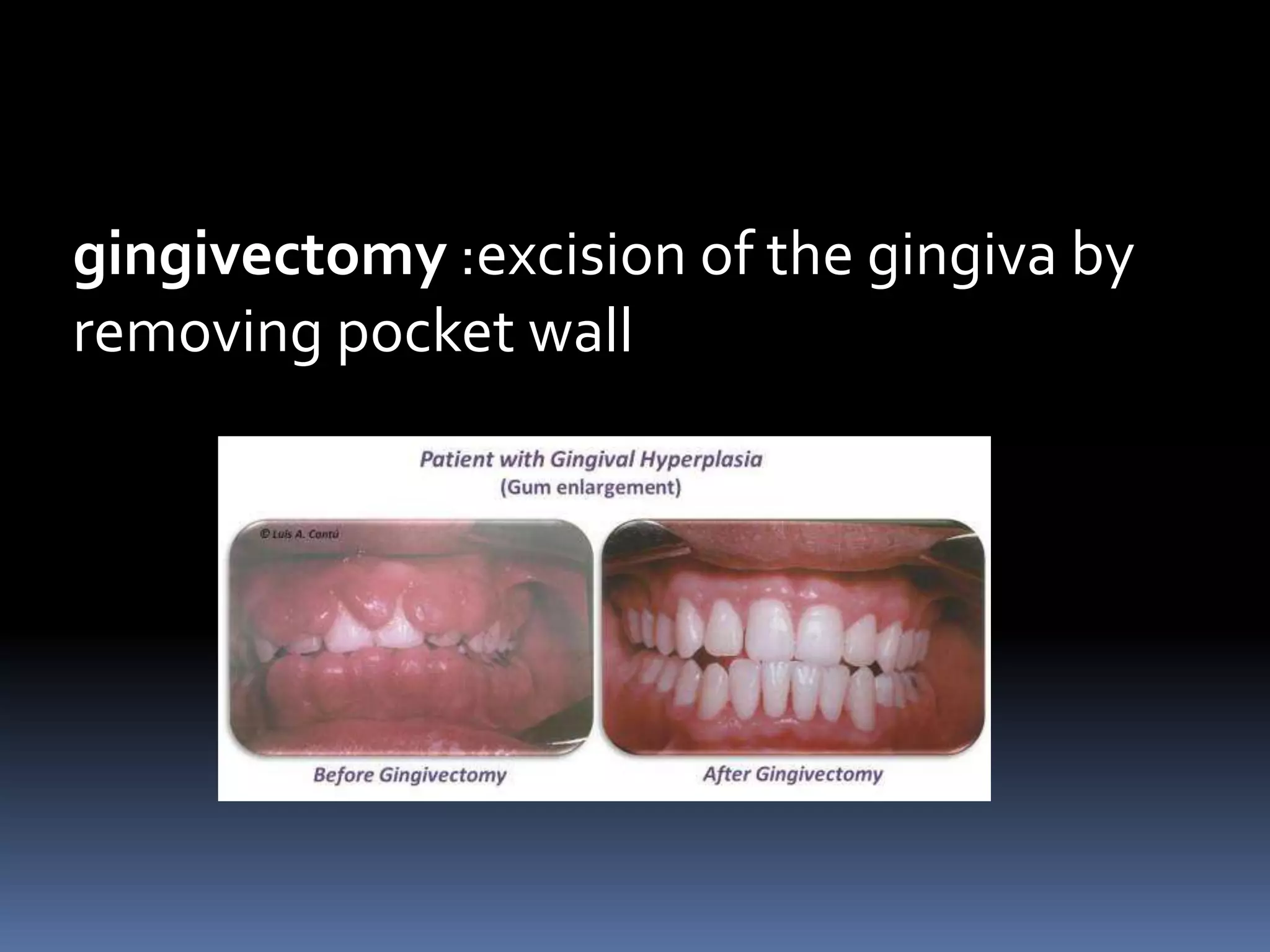 Gingivectomy | PPTX