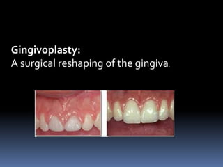 Gingivectomy | PPTX