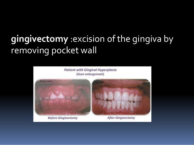Gingivectomy