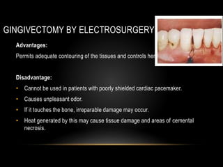 Gingivectomy | PPTX