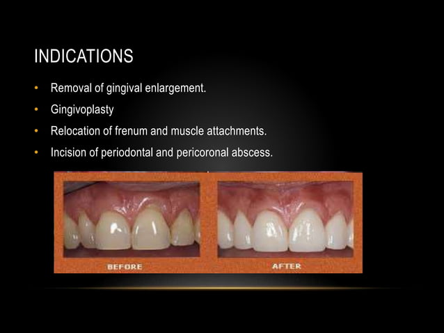 Gingivectomy | PPTX | Oral care | Personal Care