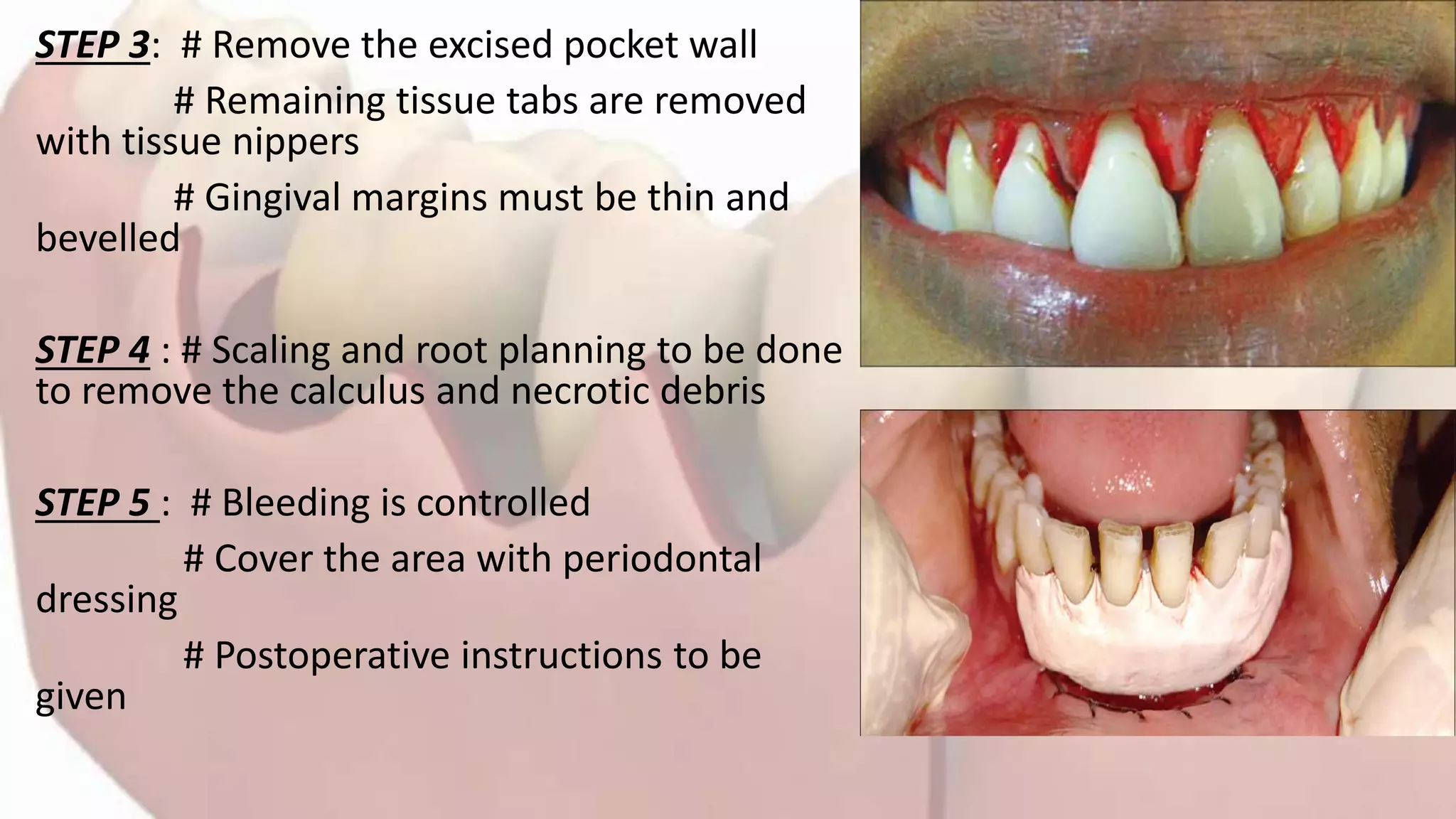Gingivectomy and Gingivoplasty | PPTX