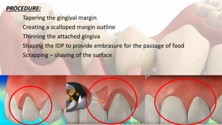 Gingivectomy and Gingivoplasty | PPTX
