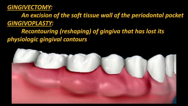 Gingivectomy and Gingivoplasty | PPTX | Dental Health | Diseases and Conditions