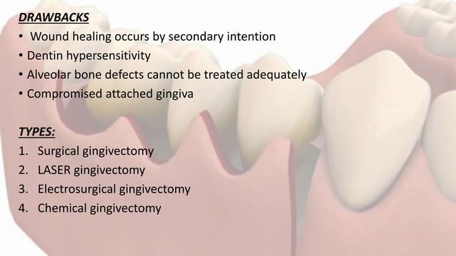 Gingivectomy and Gingivoplasty | PPTX | Dental Health | Diseases and ...