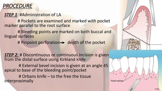 Gingivectomy and Gingivoplasty | PPTX | Dental Health | Diseases and ...