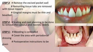Gingivectomy Incision Procedure || Gum Cutting, 59% OFF