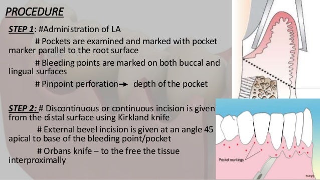 Gingivectomy and Gingivoplasty