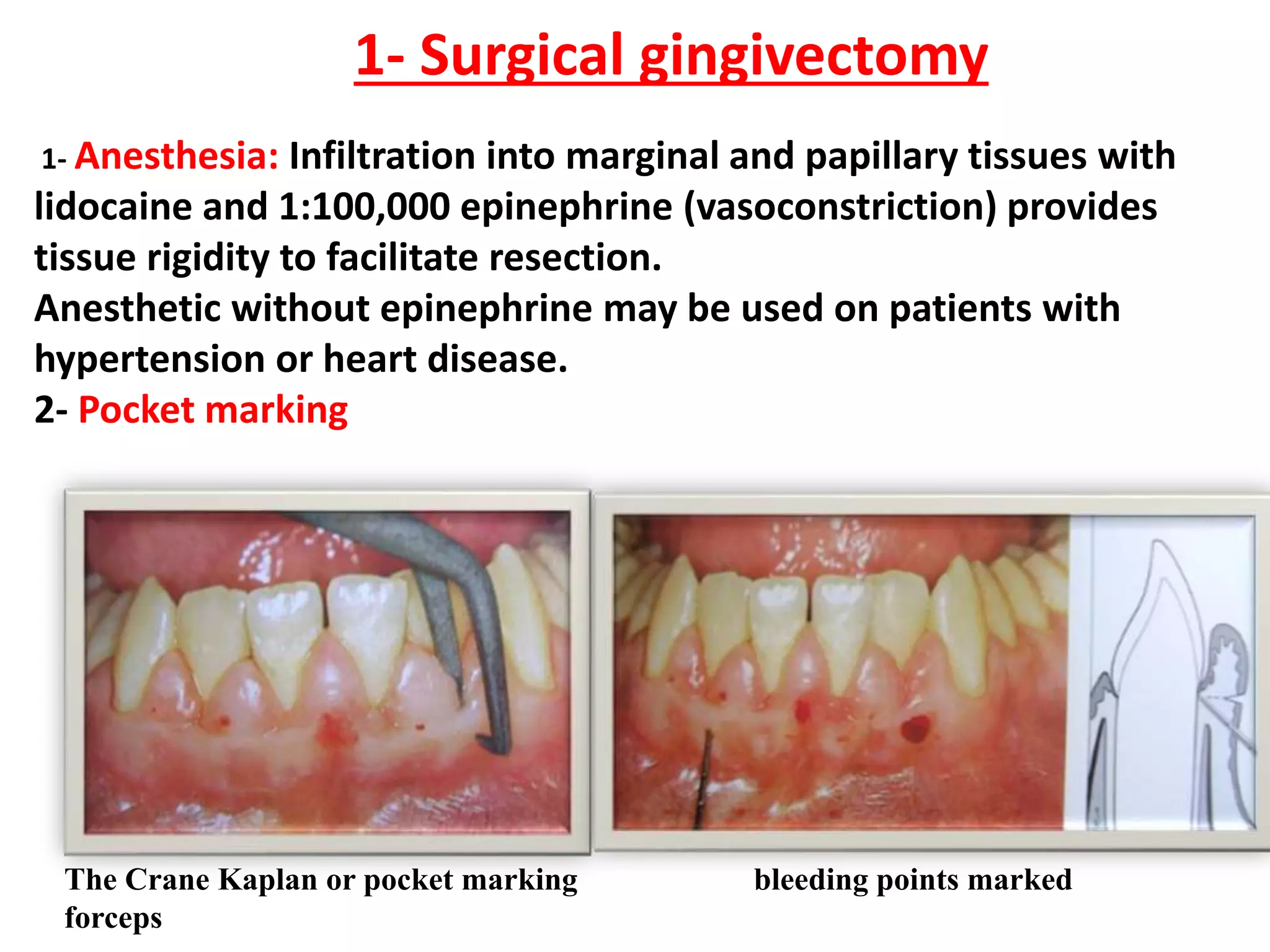 Gingivectomy | PPTX