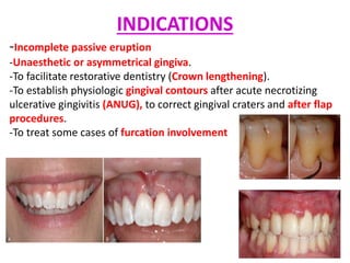 Gingivectomy | PPTX