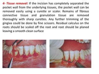 PPT Gingivectomy Procedure For Gum Disease Treatment, 57% OFF