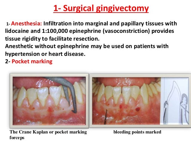 Gingivectomy
