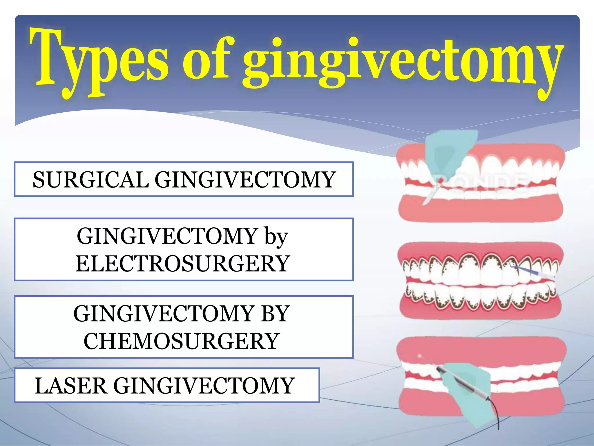 Gingivectomy | PPTX
