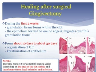 Gingivectomy | PPTX