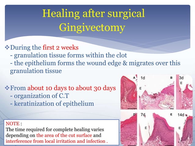 Gingivectomy | PPTX | Oral care | Personal Care