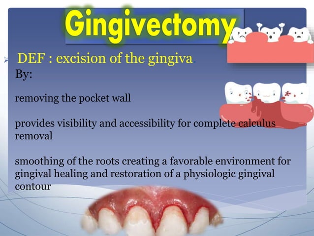 Gingivectomy | PPTX | Oral care | Personal Care