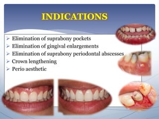 Gingivectomy | PPTX
