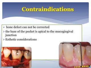 Gingivectomy | PPTX