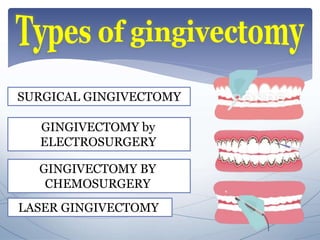 Gingivectomy | PPTX