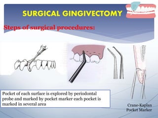 Gingivectomy | PPTX