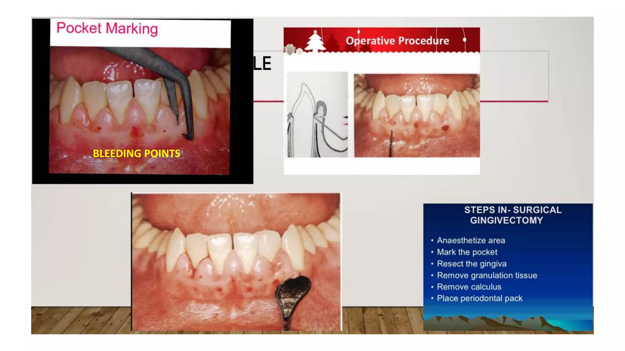 Gingivectomy | PPTX