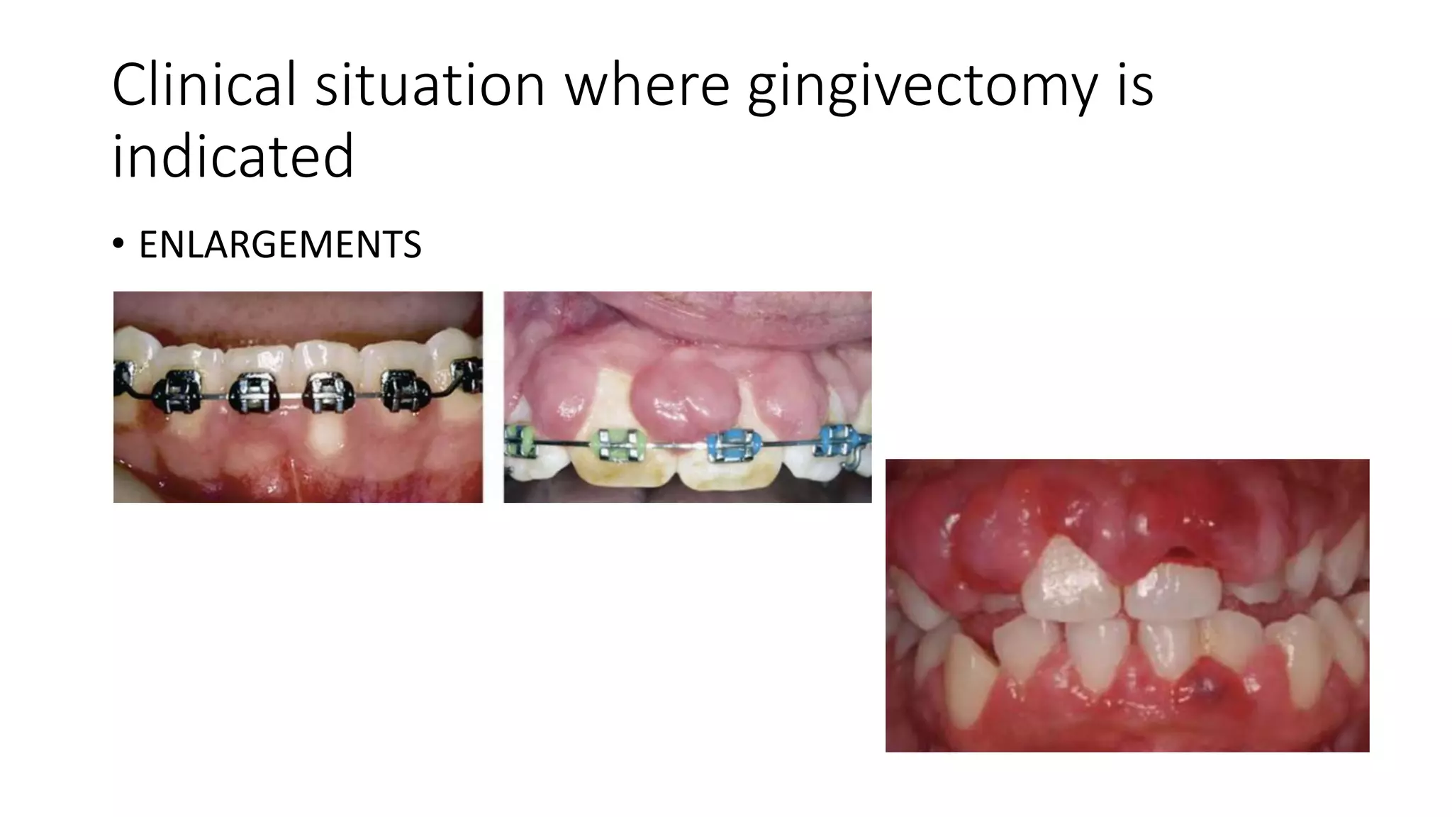 Gingivectomy | PPTX