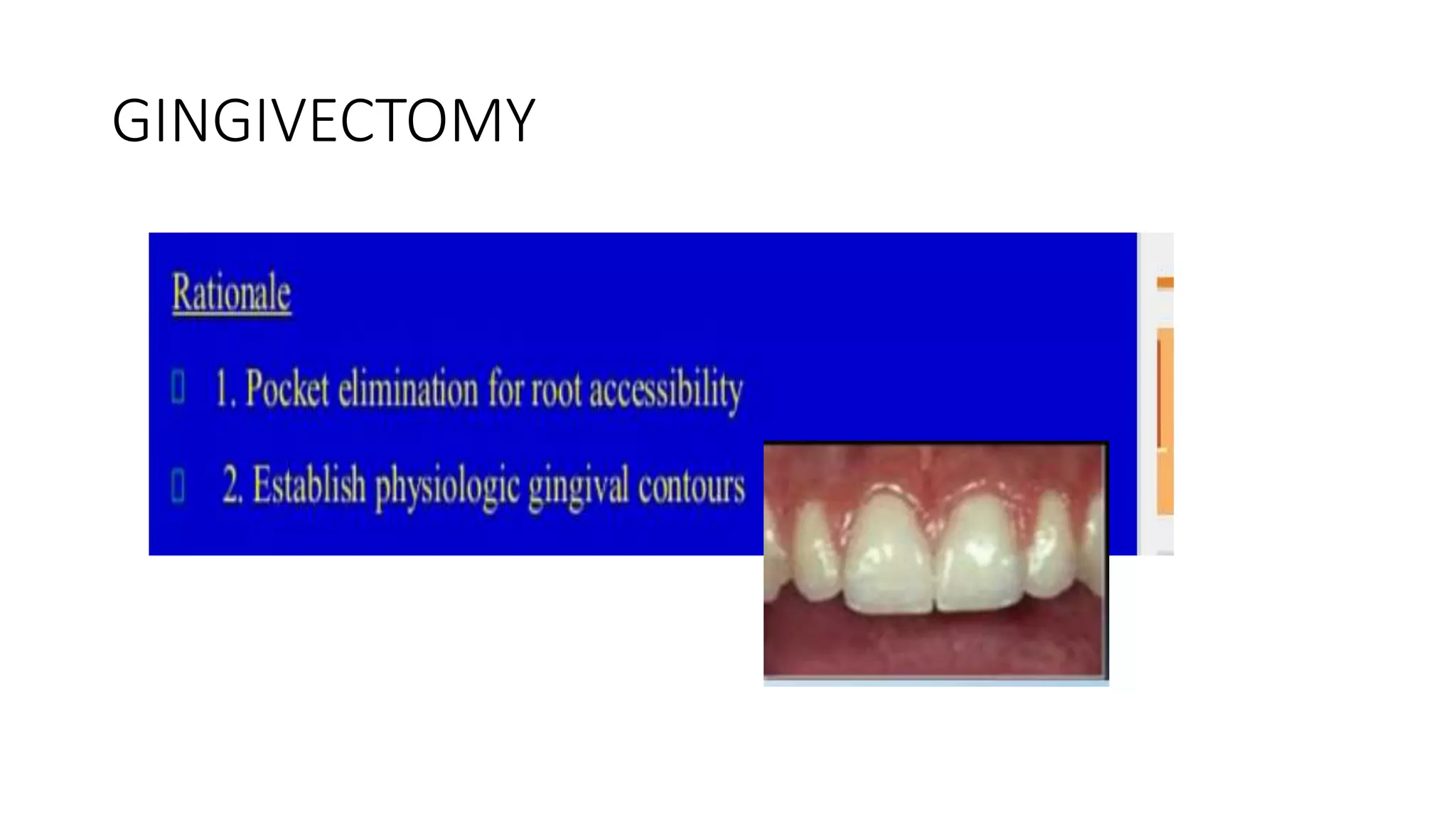 Gingivectomy | PPTX