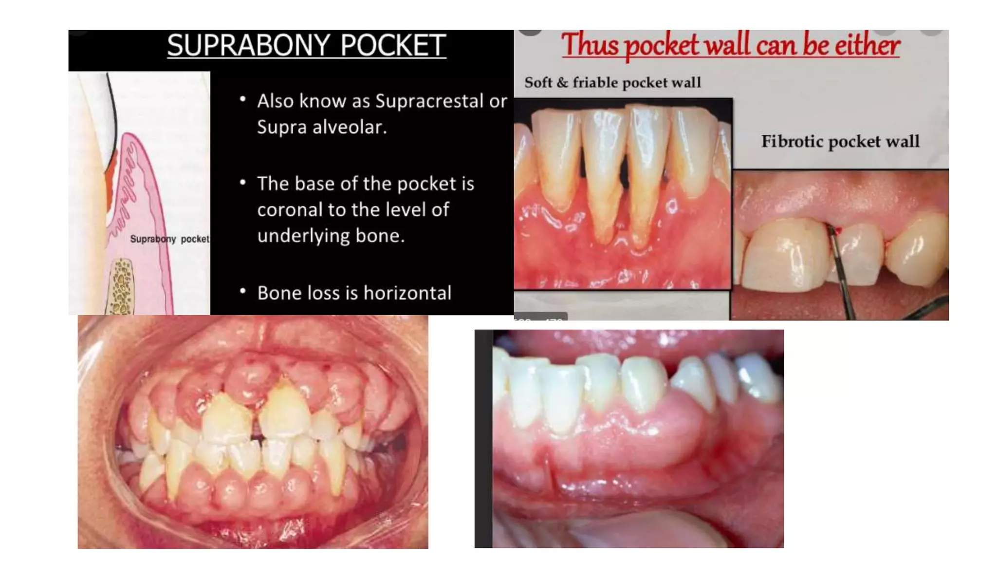 Gingivectomy | PPTX