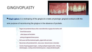 Gingivectomy | PPTX