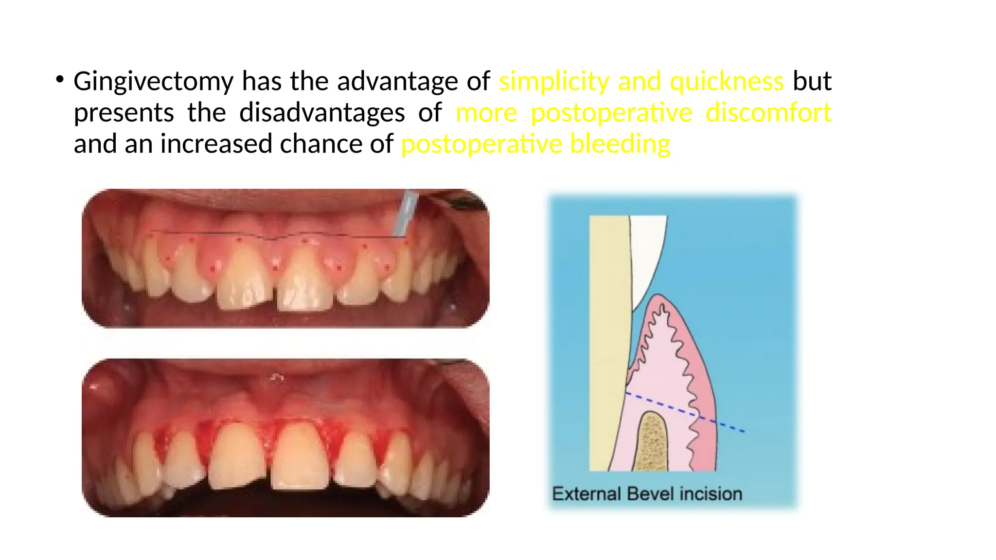 Gingivectomy in suprabony periodontal pockets | PPTX