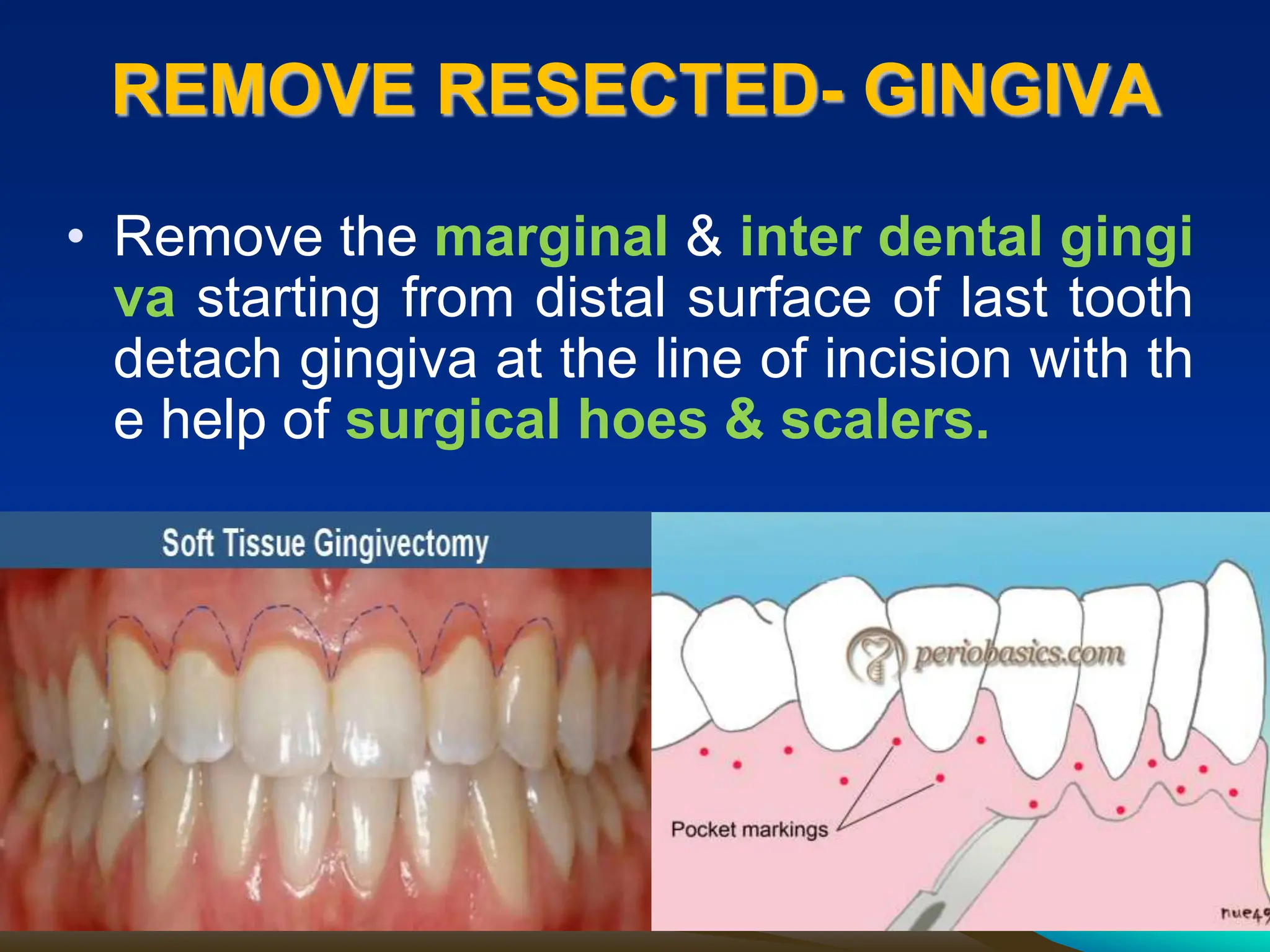 Gingivectomy .. periodontal diseases lect.Asma'a.pptx