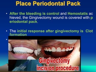 Gingivectomy .. periodontal diseases lect.Asma'a.pptx