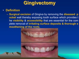 Gingivectomy .. periodontal diseases lect.Asma'a.pptx